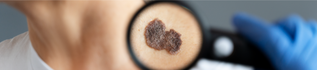Signos de alarmas – asocolderma